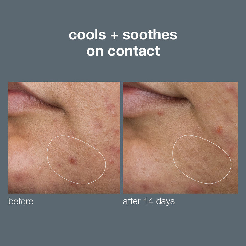 Deep Breakout Liquid Patch – Dermalogica AU