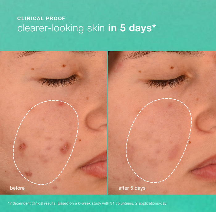 breakout biotic moisturizer – Dermalogica AU