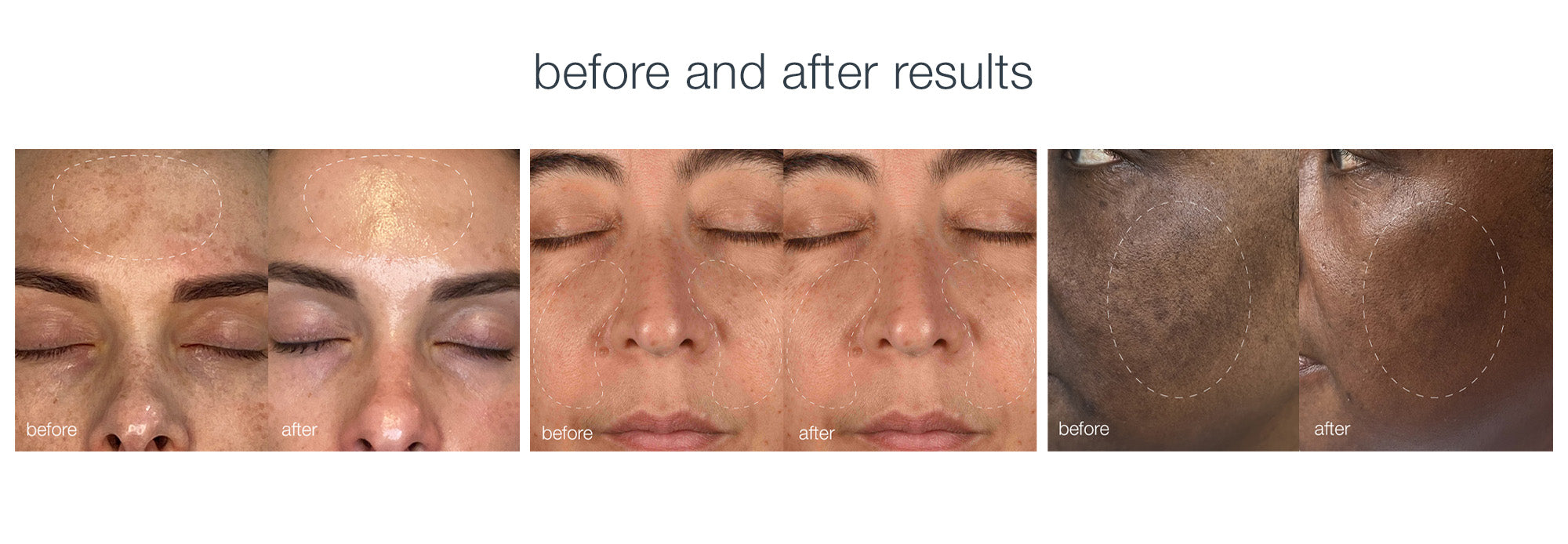 Melanopro Peel System Treatment – Dermalogica AU