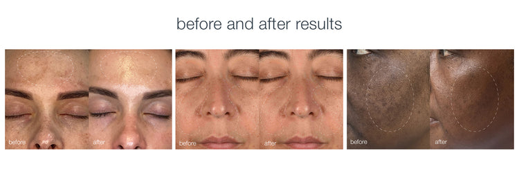 Melanopro Peel System Treatment – Dermalogica AU