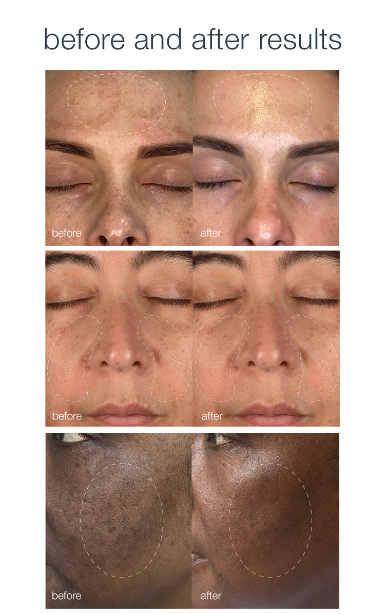 Melanopro Peel System Treatment – Dermalogica AU